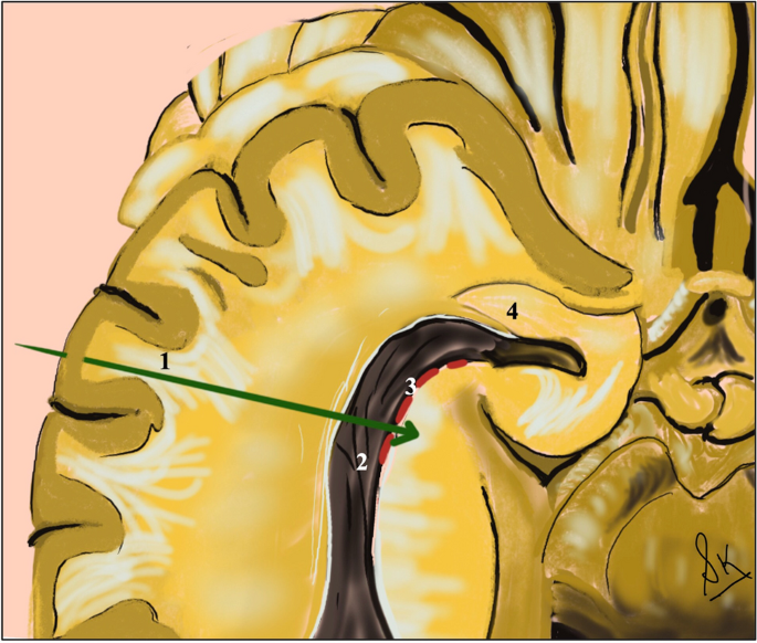 Trans-temporal trans-choroidal resection of thalamic and ...