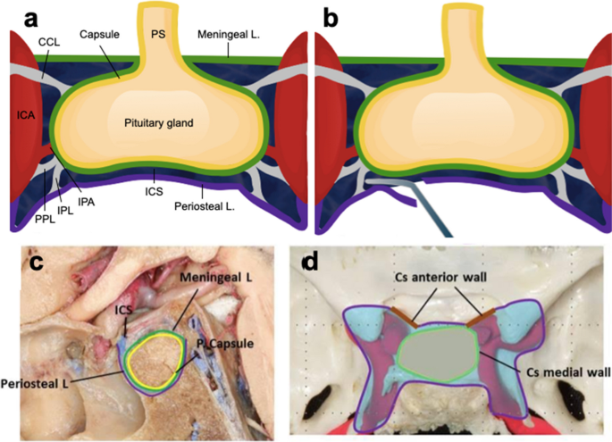 How I do it: Endoscopic endonasal resection of the medial wall of the ...