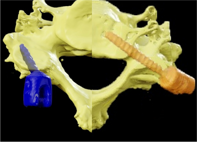 Pars interarticularis screws for posterior cervical fusion ...
