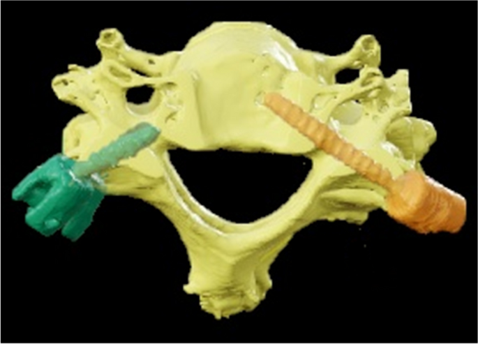 Pars interarticularis screws for posterior cervical fusion ...