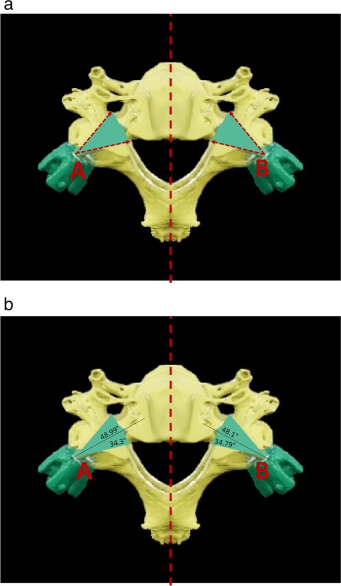 Pars interarticularis screws for posterior cervical fusion ...