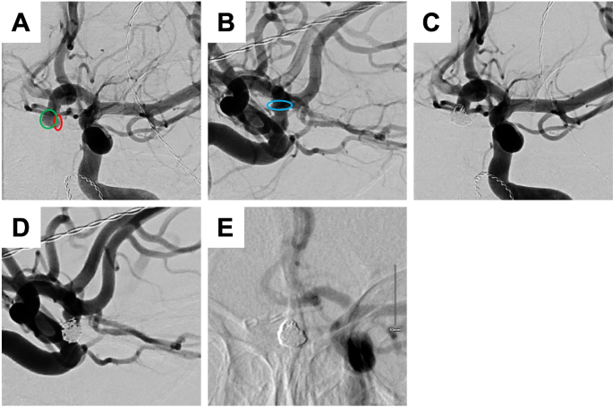 Partial coil embolization before surgical clipping of ruptured ...