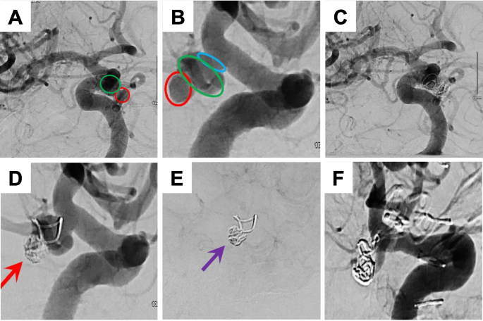 Partial coil embolization before surgical clipping of ruptured ...