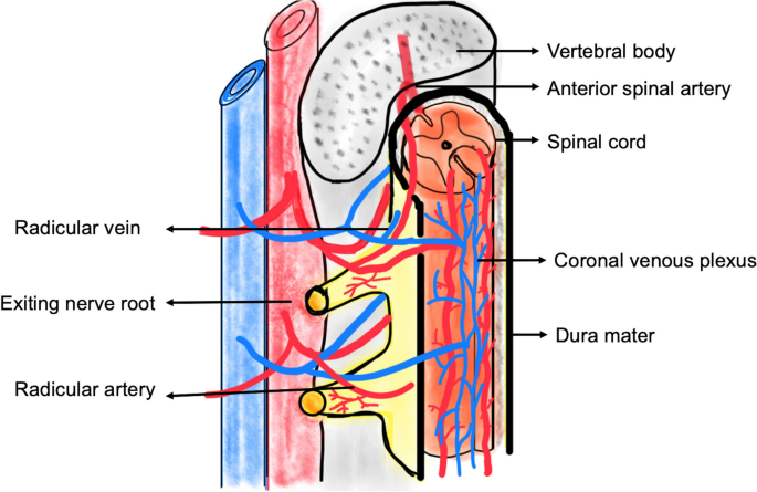 How I do it: Exoscope assisted microsurgical ligation of type 1 spinal ...