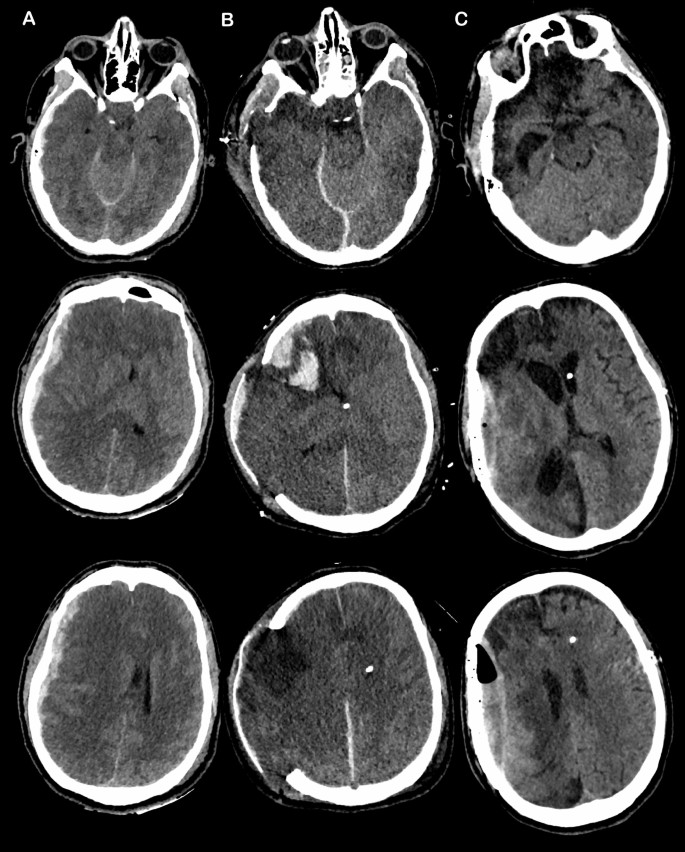Indications and scientific support for supratentorial unilateral ...