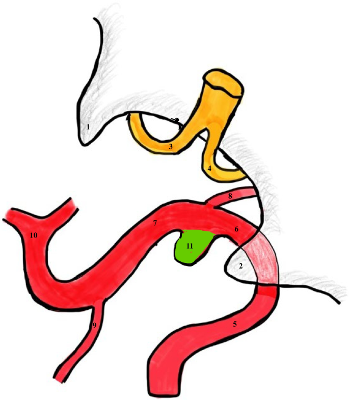 How I do it—Dolenc approach for clipping of ventral wall paraclinoid ...