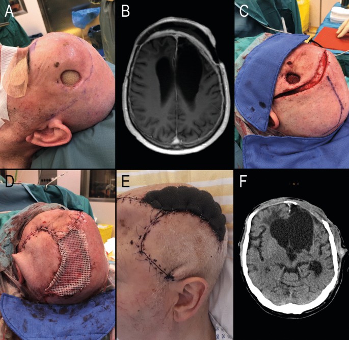 Challenging frontiers in neuroplastic cranial reconstruction ...