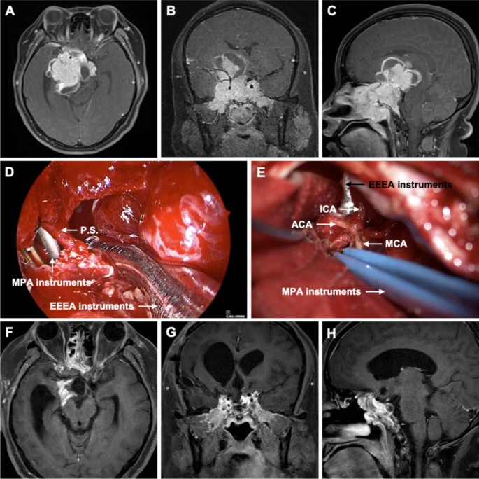 Different types of combined endoscopic and transcranial approaches for ...