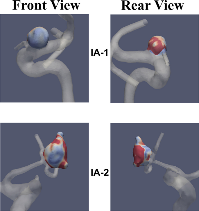 Improving rupture status prediction for intracranial aneurysms using wall shear stress ...