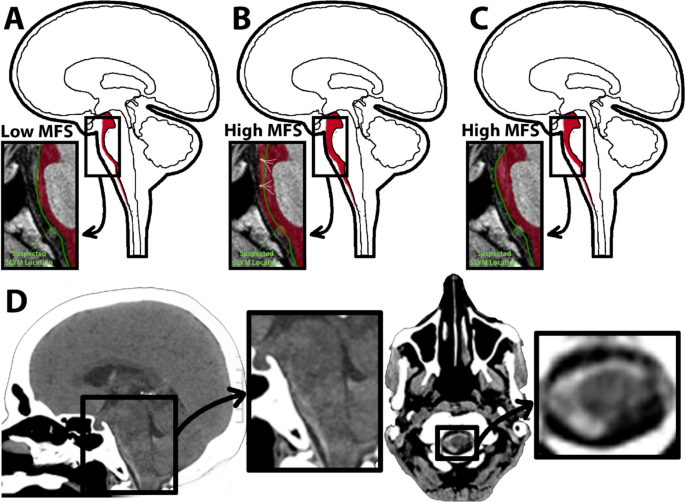 Assessing the subarachnoid space anatomy on clinical imaging: utilizing ...
