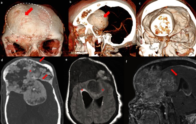 Two-stage surgical strategy for extensive craniofacial fibrous ...
