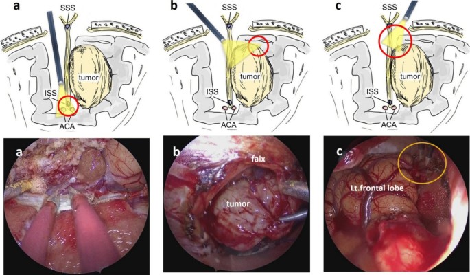Endoscopic-assisted contralateral interhemispheric transfalcine keyhole ...