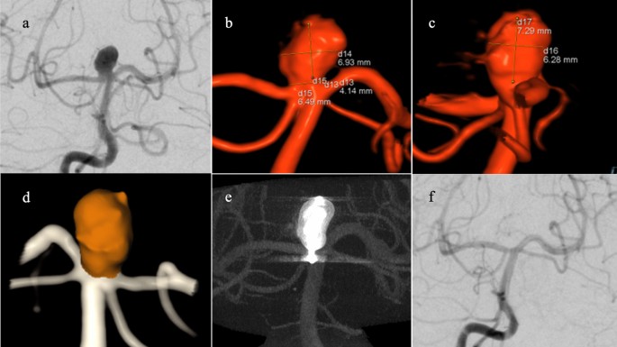 Optimal woven endobridge (WEB) device-aneurysm volume: using automated ...