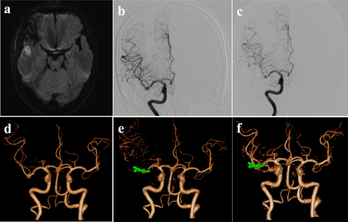 Cerebral vasospasm following clipping of unruptured middle cerebral ...