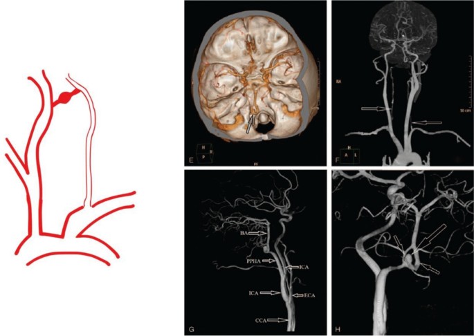 Persistent primitive hypoglossal artery: a classification-based ...