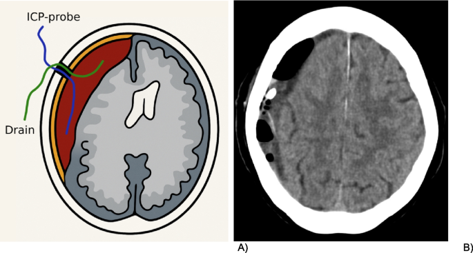 Intracranial pressure changes during early postoperative mobilization ...