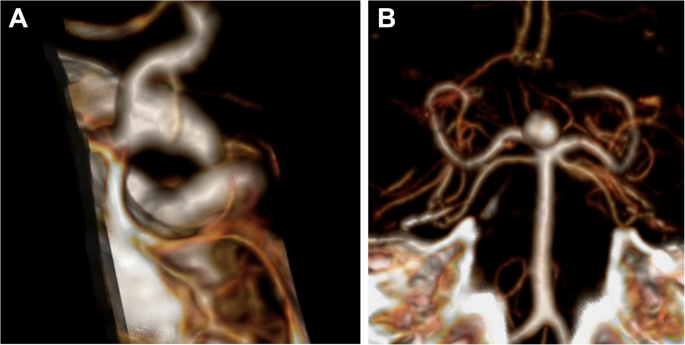 Basilar apex artery aneurysm clipping: how I do it | Acta ...