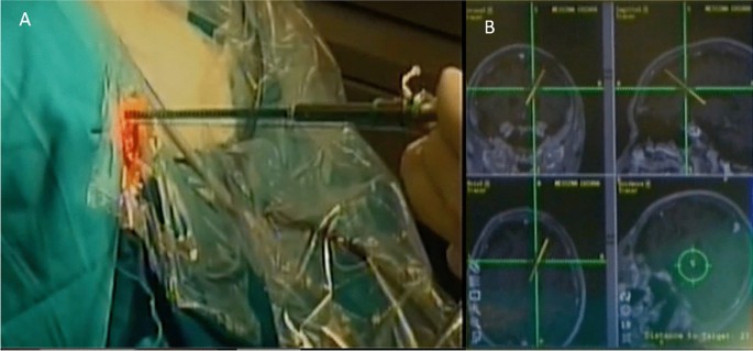 How I do it: continuous intraventricular interferon alpha infusion in ...