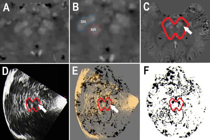 High correlation of quantitative susceptibility mapping and echo ...
