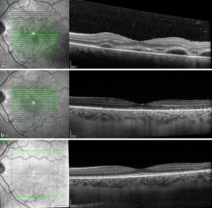 Multimodales Imaging bei Uveitis | Spektrum der Augenheilkunde