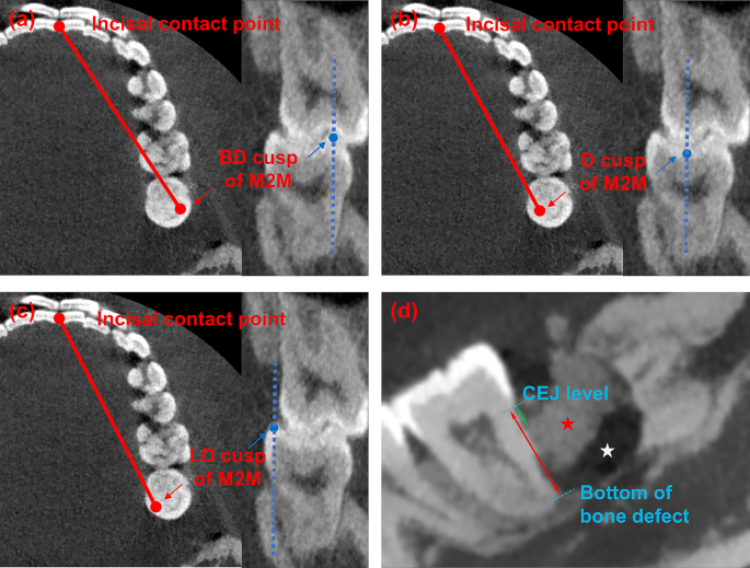 Effect of mineralized dentin matrix on the prognosis of bone defect and ...