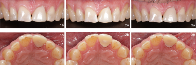 Biological interaction, esthetics, handling, and loss rate of temporary ...