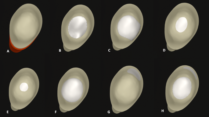 Influence of endodontic access cavity design on mechanical properties ...