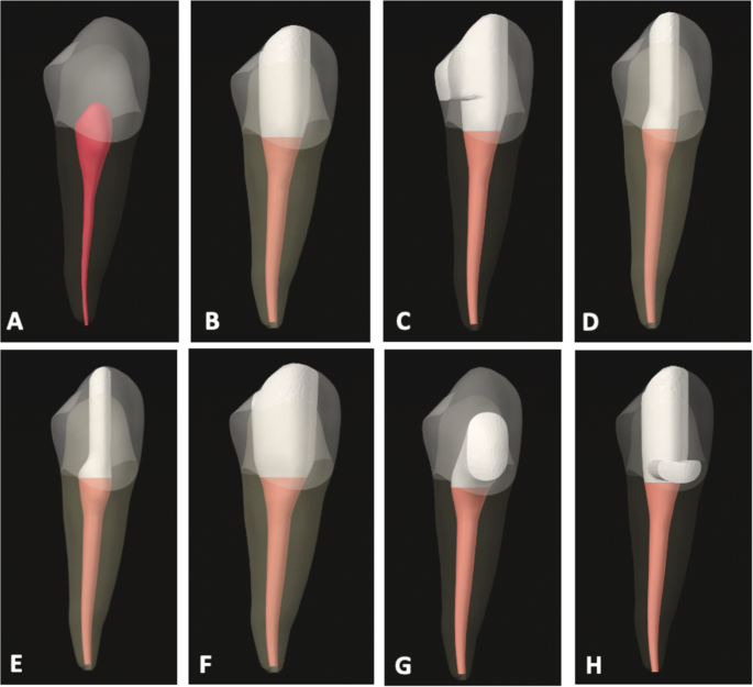 Influence of endodontic access cavity design on mechanical properties ...