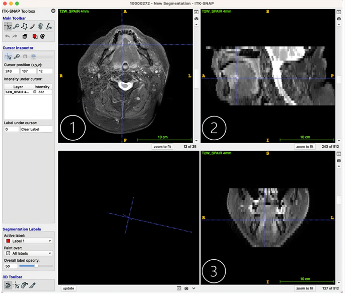 Comparative analysis of volumetric changes between resection volume of ...
