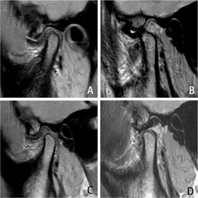 Physical therapy and non-surgical manual disc reduction combined with ...