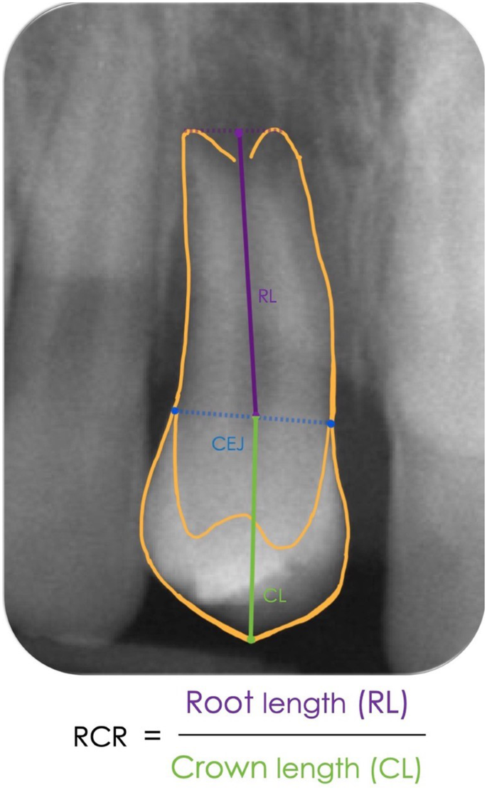 Application of orthodontic force in autotransplanted teeth: a ...