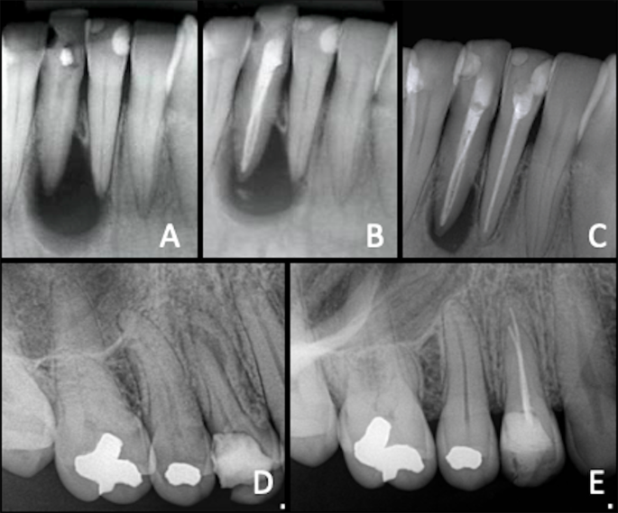 Clinical and imaging aspects associated with persistent apical ...