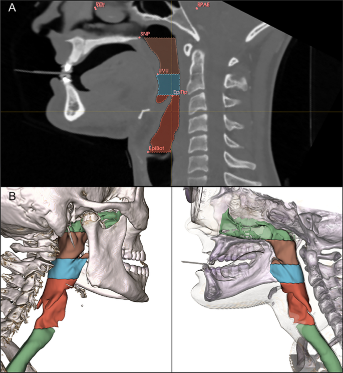 The effect of mandibular advancement on pharyngeal airway space in ...