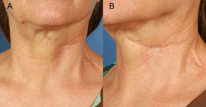 Surgical complications and quality of life according to the extent of ...