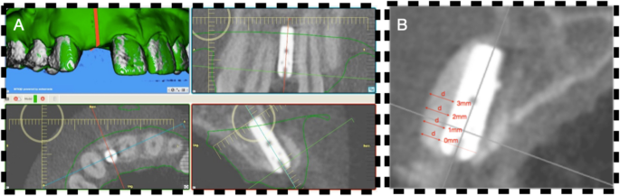 Hard and soft tissue contour changes following simultaneous guided bone ...