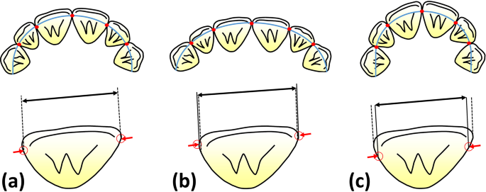 Influence of dental arch width changes on the effective space required ...