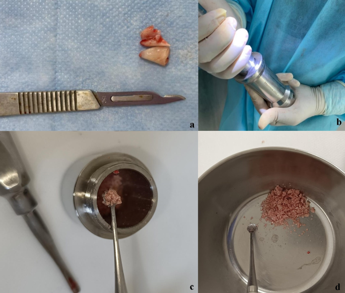 Clinical, tomographic, and histological analysis of post-extraction ...