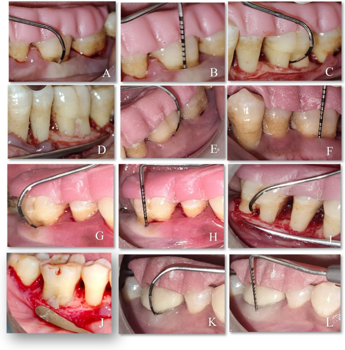 Comparative evaluation of demineralized freeze-dried bone allograft ...