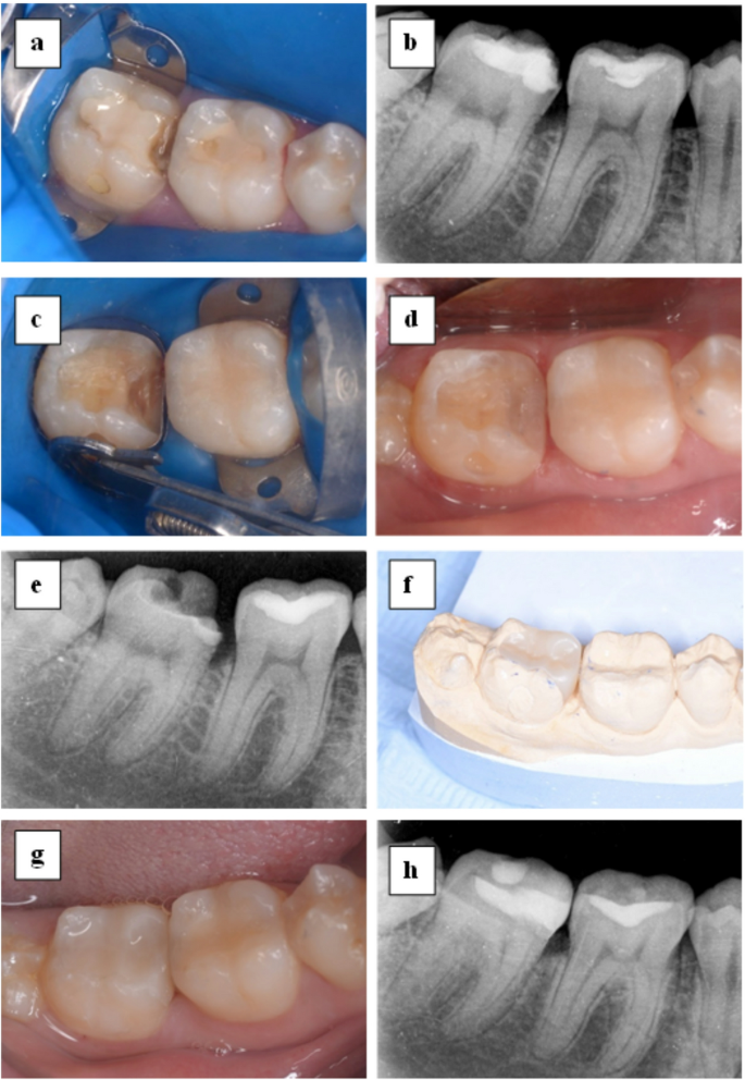 Effect of deep margin elevation with different injectable materials on ...