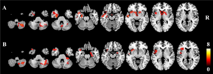 Functional connectivity density of brain in children with primary ...