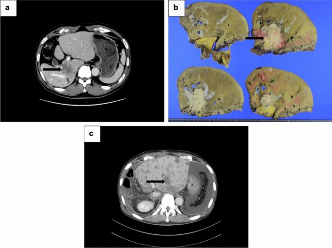 Hepatic adenosquamous carcinoma with sarcomatous transformation: a case ...