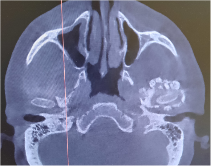 TMJ synovial chondromatosis – an evaluation of 37 patients | Oral and ...