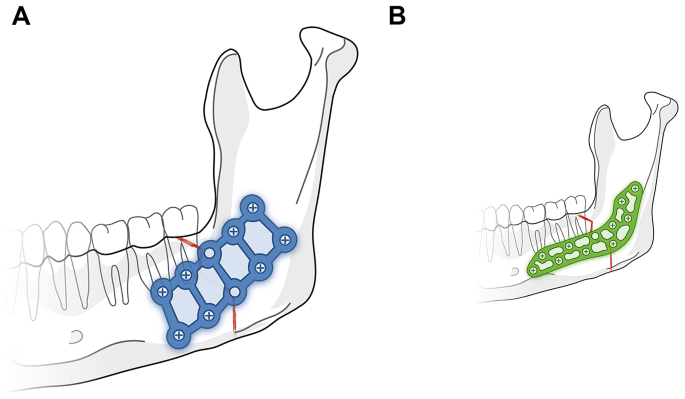 Clinical results of two different three-dimensional plate types for the ...