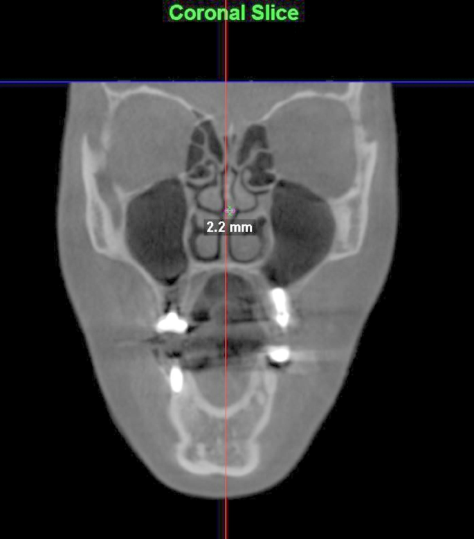 Assessment of the prevalence of nasal deviation in patients requiring ...