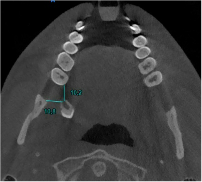 MR imaging evaluation of accidental third molar displacement into ...