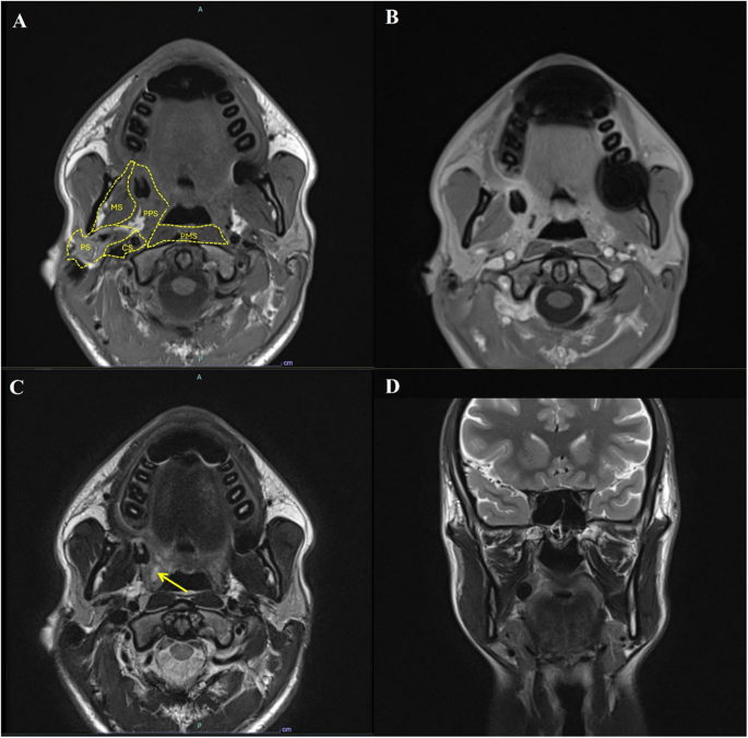 MR imaging evaluation of accidental third molar displacement into ...