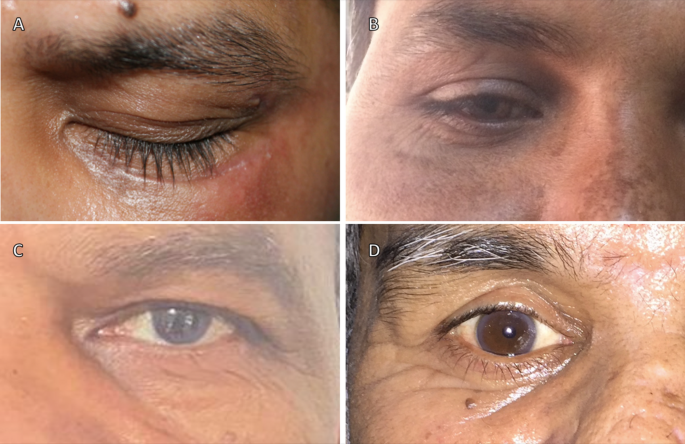 Influence of Fitzpatrick skin type on Scar maturation following ...