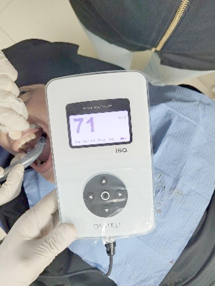 Osseodensification by Densah burs in combination with activated plasma ...