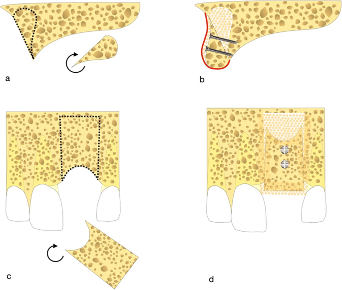 In situ flip osteotomy bone block: an alternative bone graft harvesting ...