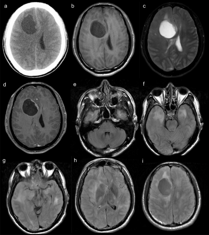 Diffuse midline glioma, H3K27-altered: a rare presentation with ...